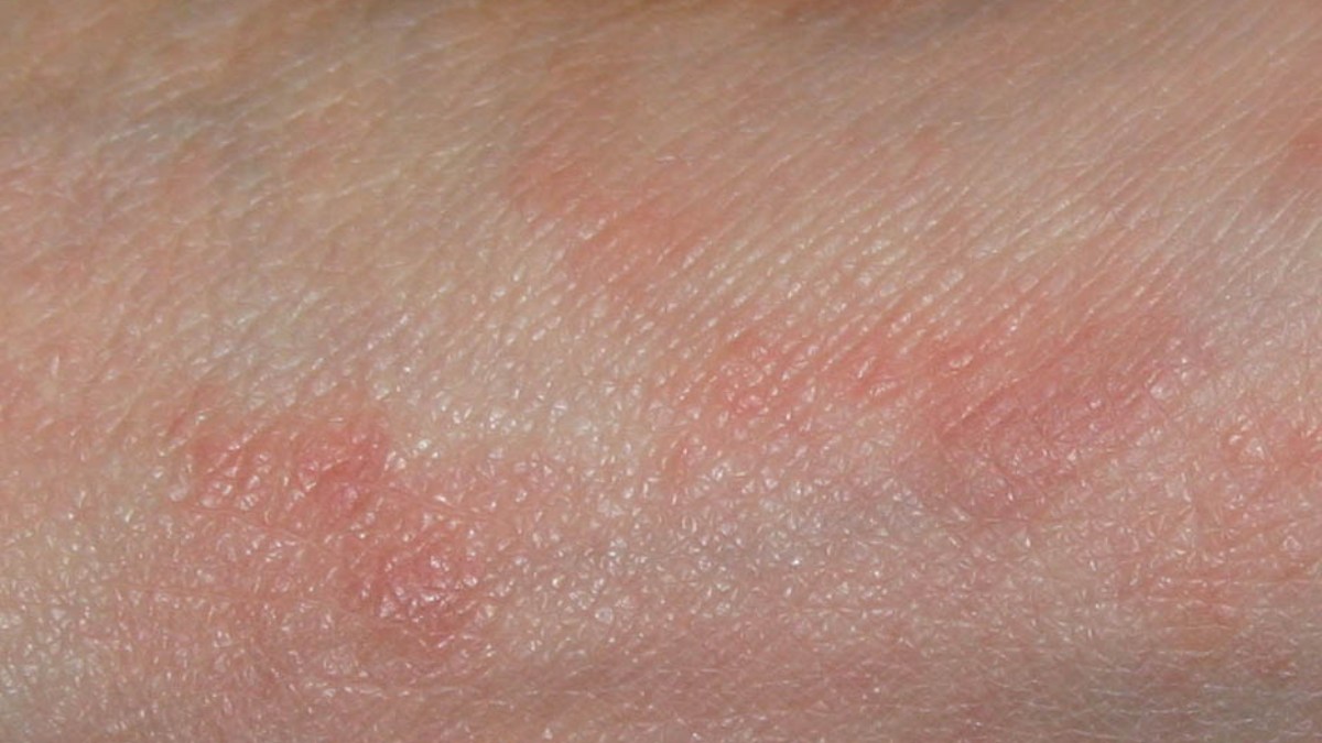 Svrab si přivezla domů v sedačce. Nemoc se v Česku nekontrolovaně šíří